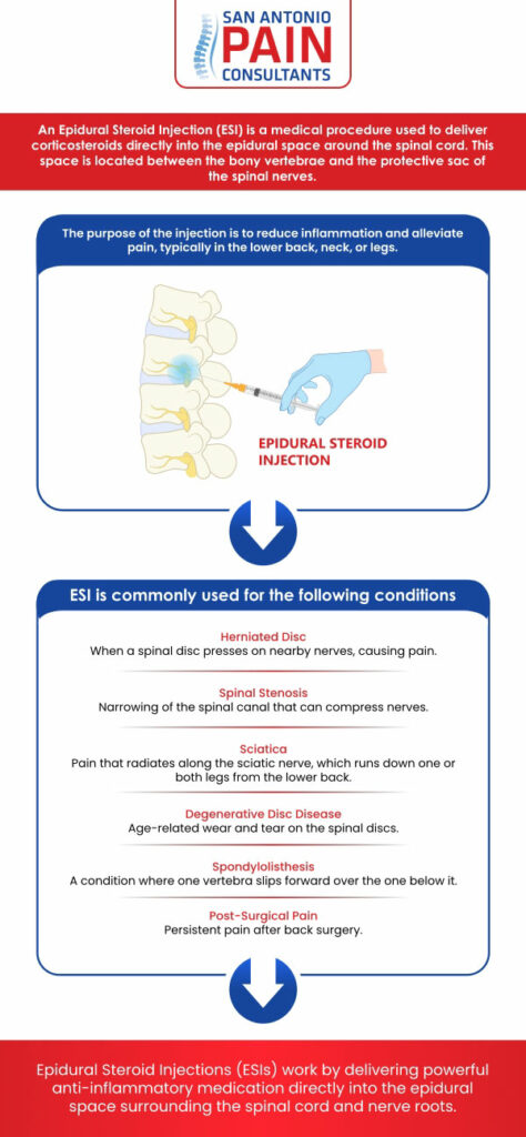 Epidural Steroid Injection Near Me in San Antonio, TX